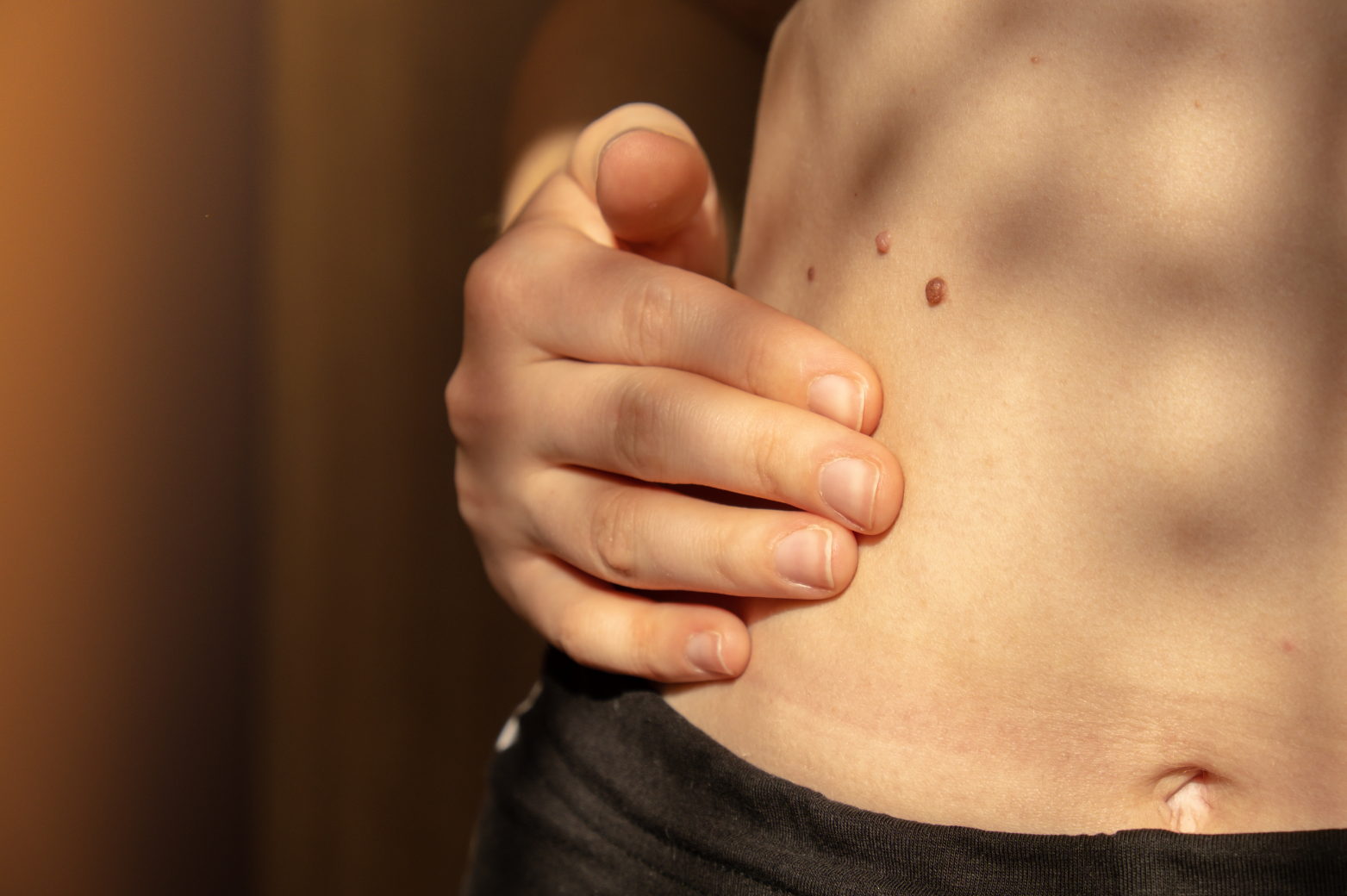 ENTFERNUNG VON HAUTANHÄNGSELN – Dermalaserzentrum